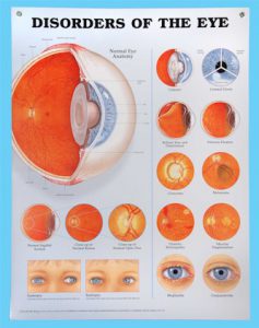 Disorders Of The Eye Poster