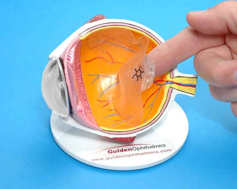 Posterior Vitreous Detachment (PVD) Model - Gulden Ophthalmics
