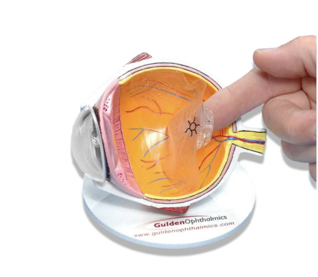 Posterior Vitreous Detachment (PVD) Model - Gulden Ophthalmics